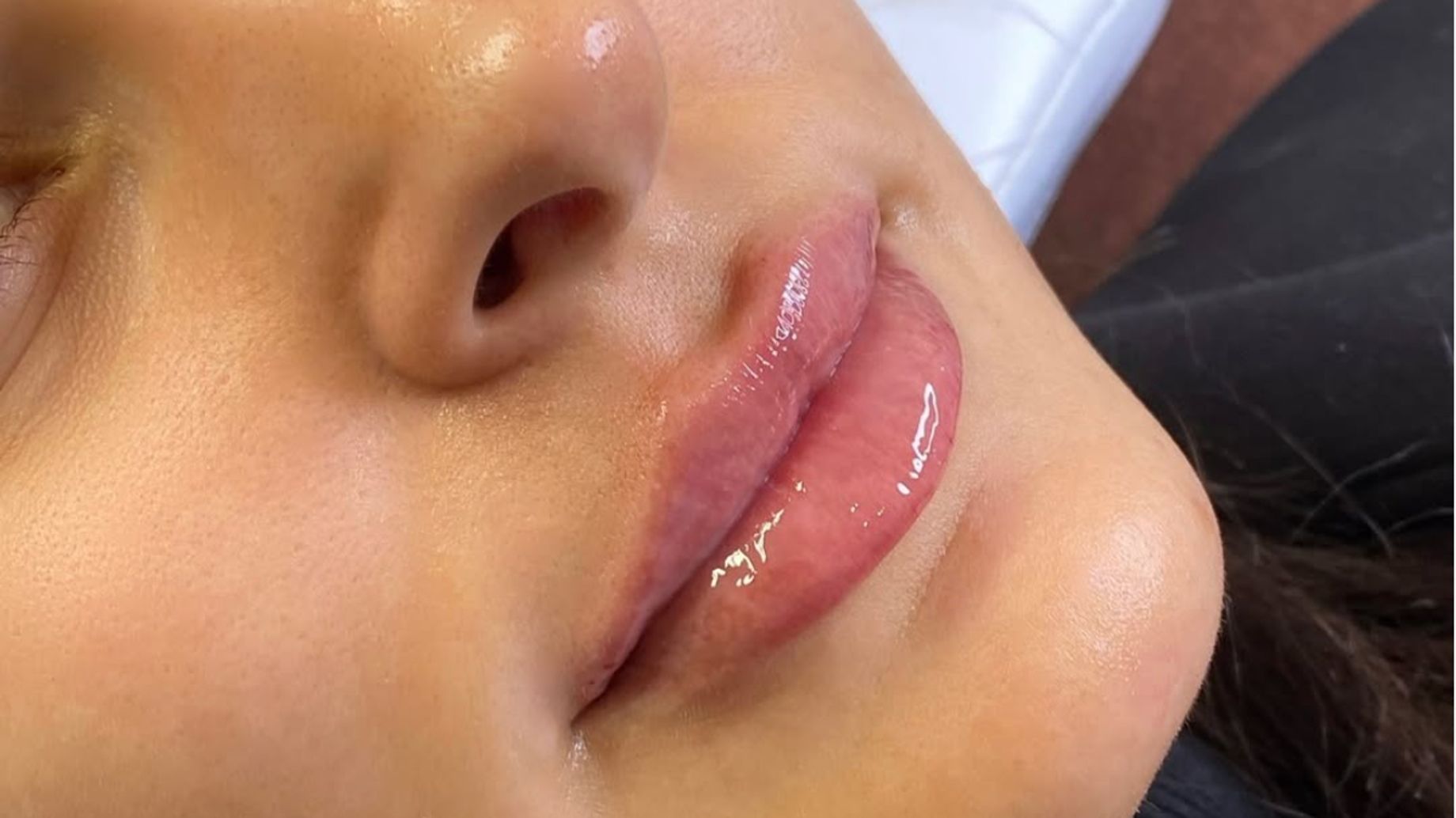 Lip Fillers: Natural Lip Augmentation for Fuller, Plump Lips